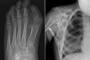 17-year-old girl with 'stone man syndrome' is growing a SECOND skeleton ...